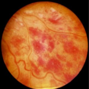 Glaucomul neovascular – studiu clinic retrospectiv – Societatea Română ...